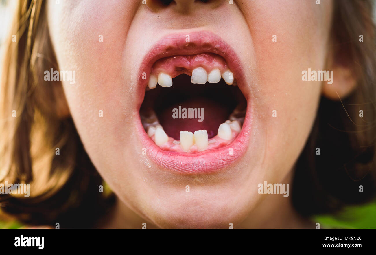 Portrait of toothless child girl missing milk and permanent teeth ...