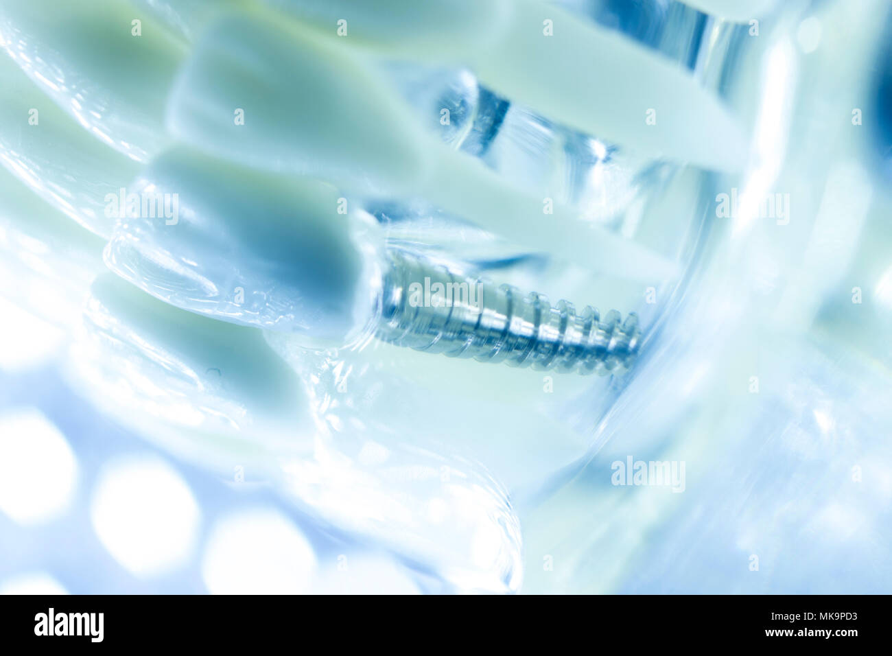 Dental titanium aesthetic orthodontic tooth implant in dentists mouth ...