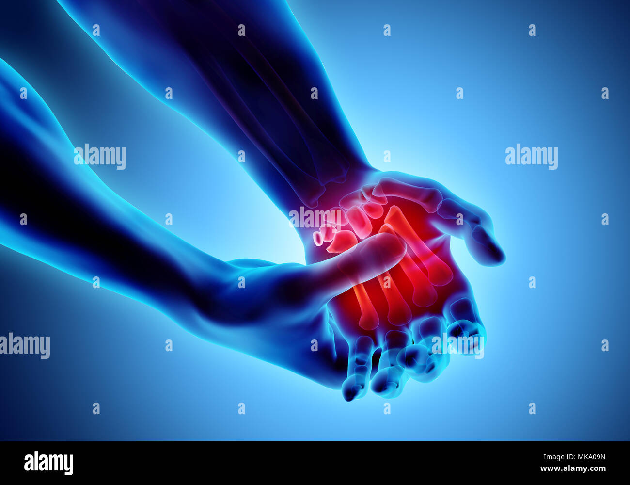 3D illustration of Palm painful - skeleton x-ray, medical concept Stock ...