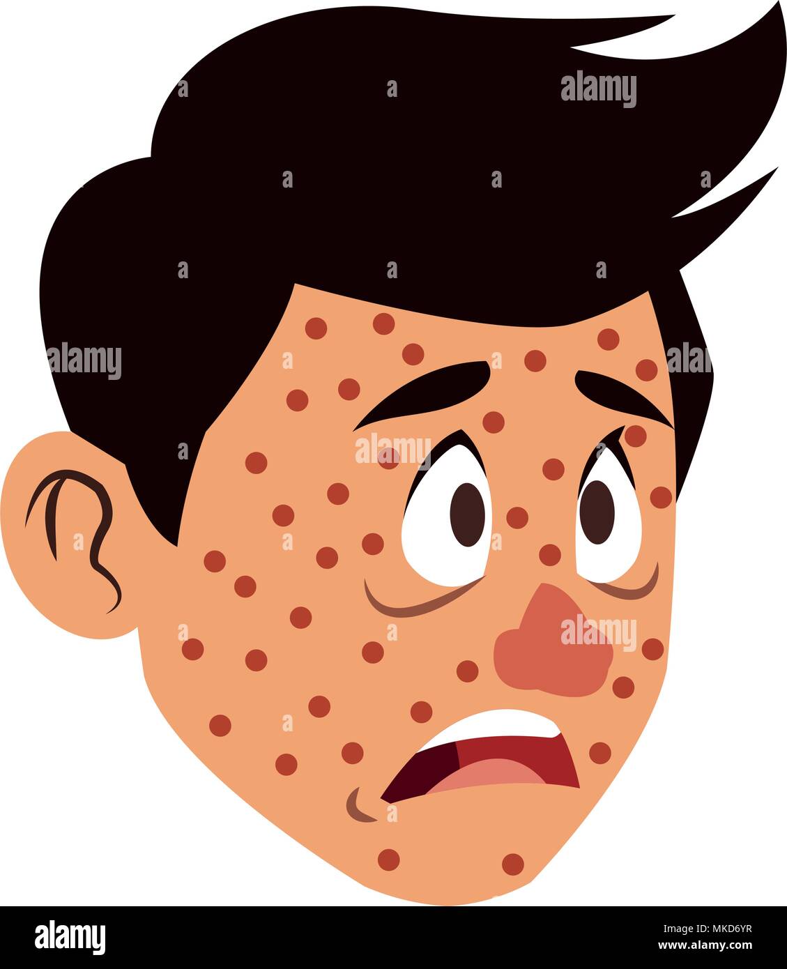 Man face with chickenpox Stock Vector Image & Art - Alamy