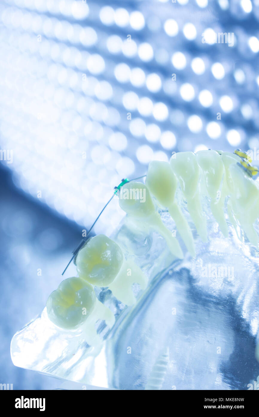 Orthodontics dentists teaching model dental teeth plastic and metal ...