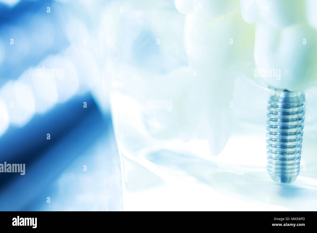 Dental titanium aesthetic orthodontic tooth implant in dentists mouth ...