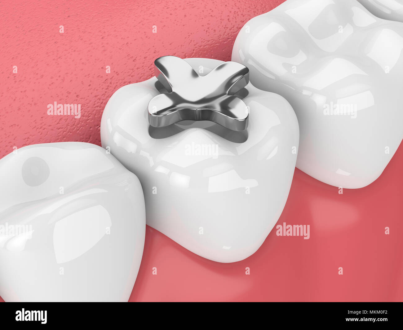 3d render of teeth with dental amalgam inlay filling in gums over white ...