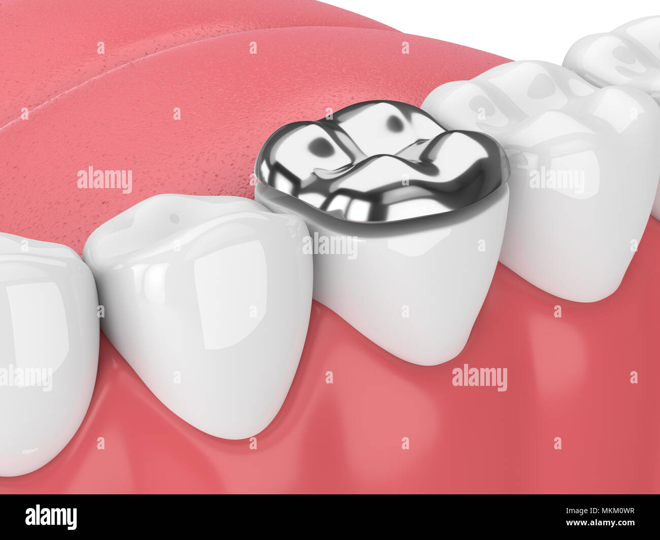 3d render of teeth with dental onlay amalgam filling over white ...