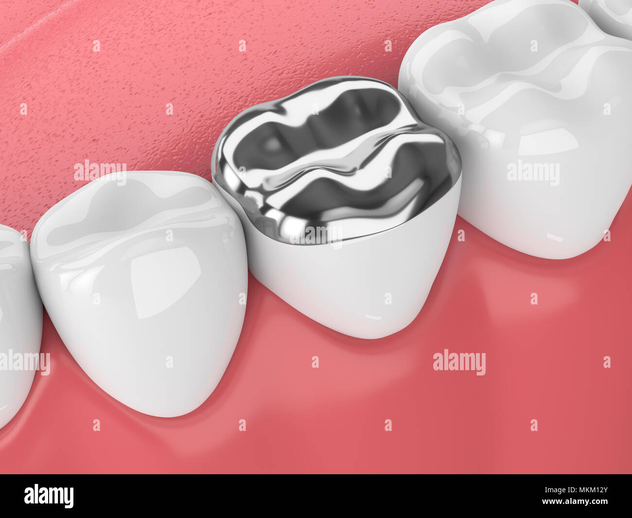 3d render of teeth with dental onlay amalgam filling over white ...