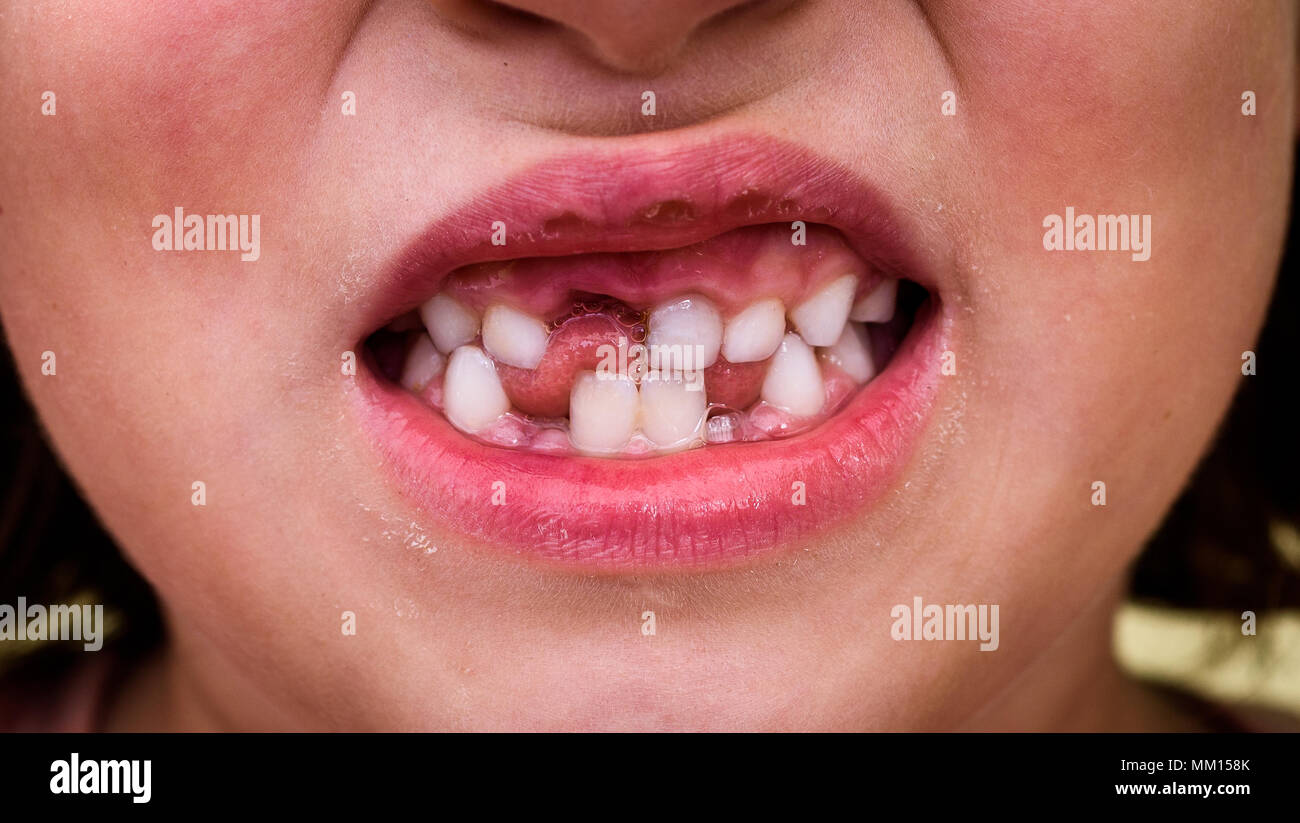 Portrait of toothless child girl missing milk and permanent teeth ...