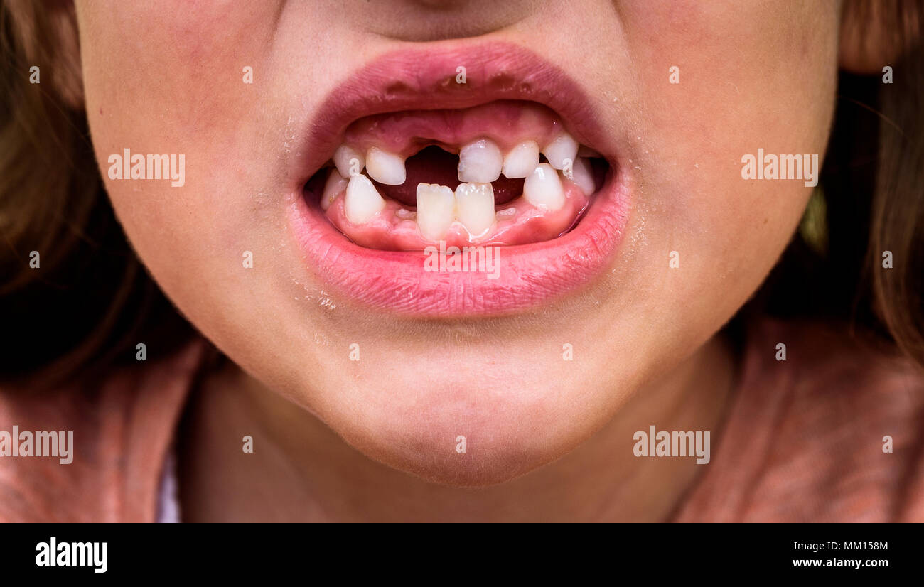 Portrait of toothless child girl missing milk and permanent teeth ...