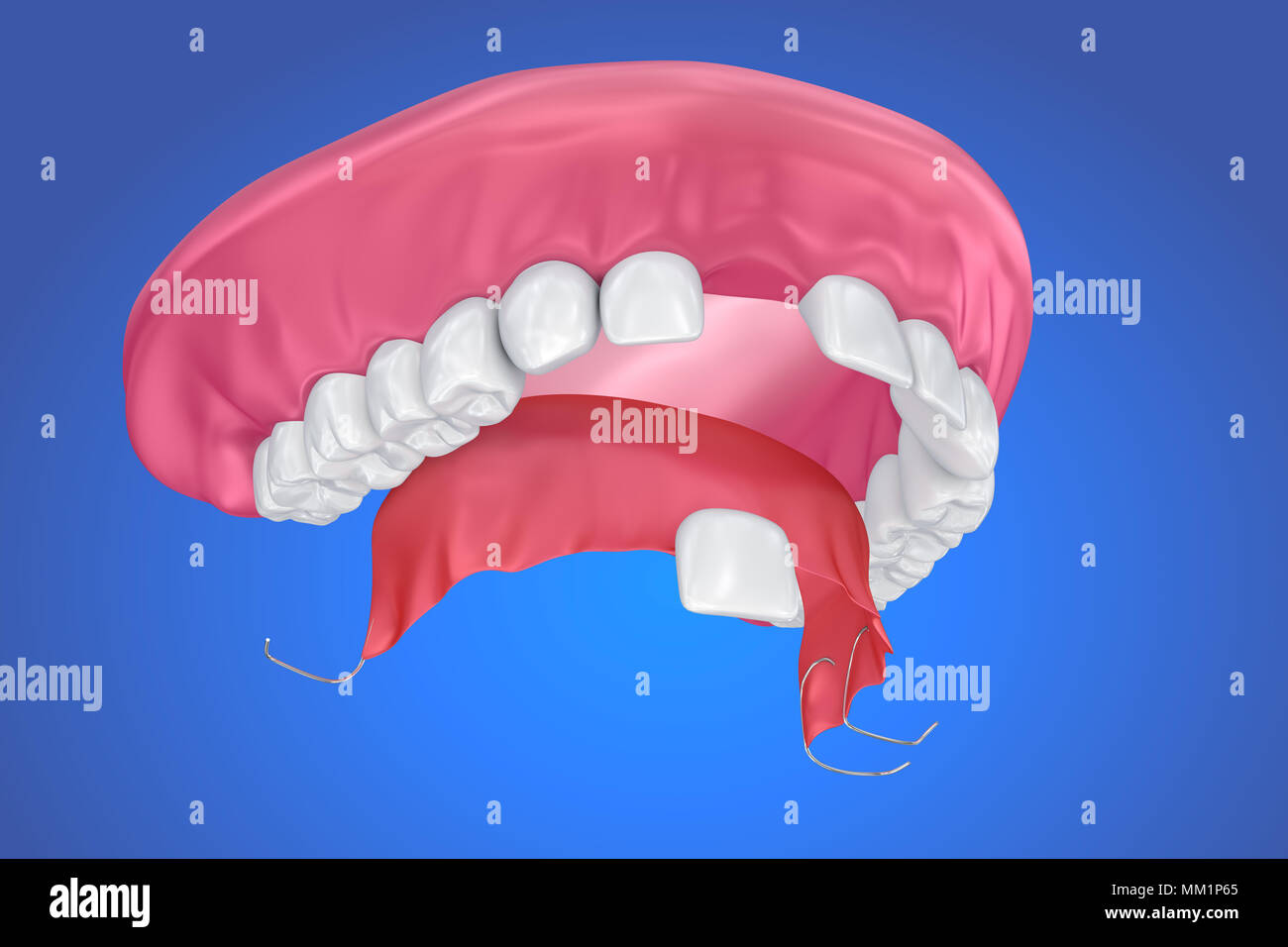 Single Missing Tooth - Removable partial denture . 3D illustration ...
