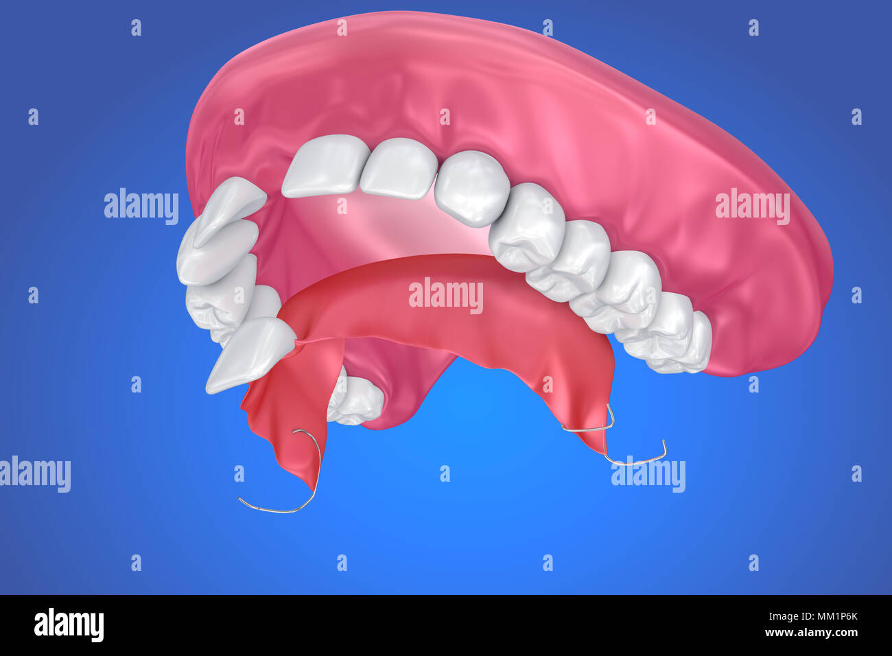 Single Missing Tooth - Removable partial denture . 3D illustration ...