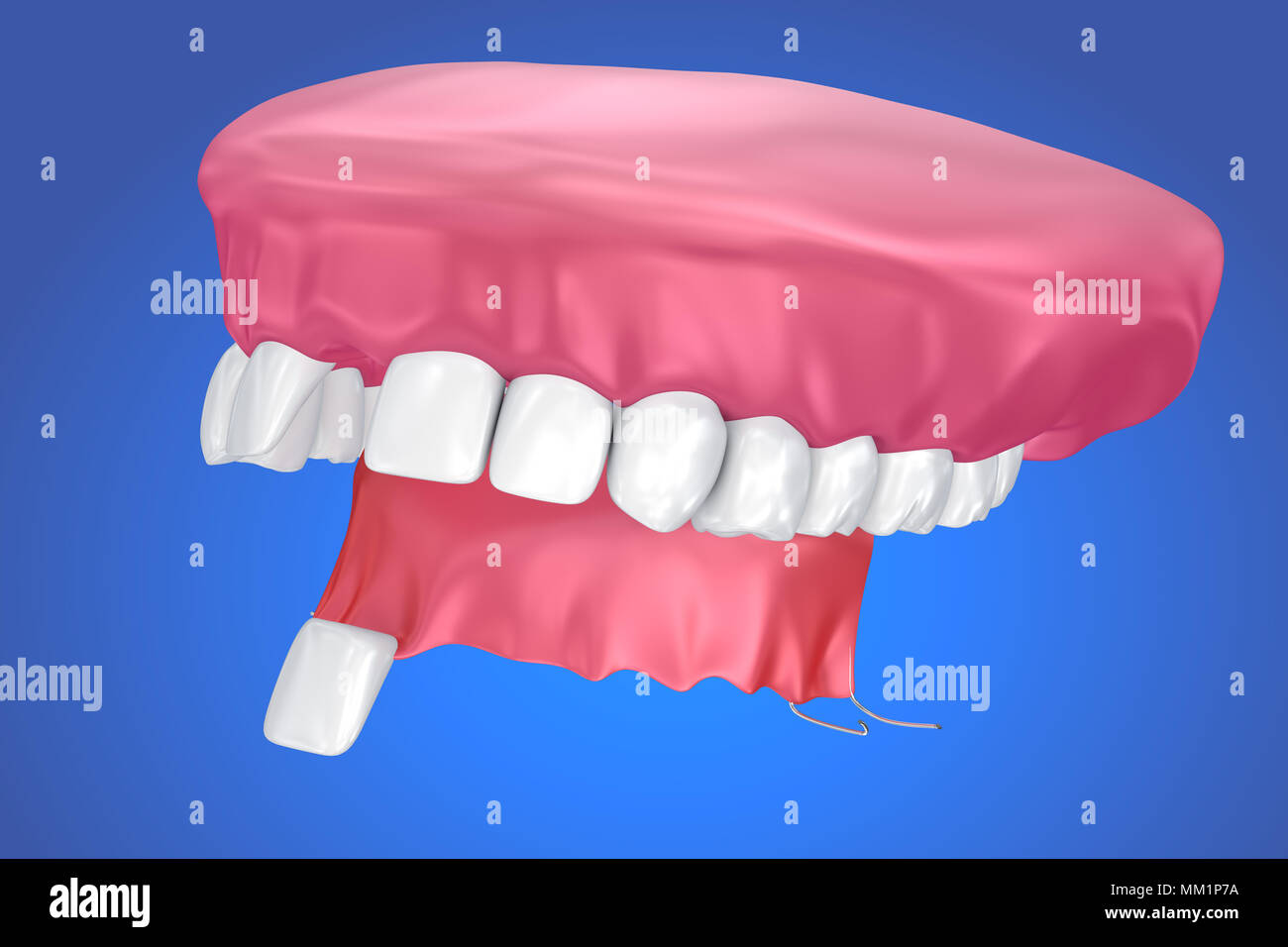 Single Missing Tooth - Removable partial denture . 3D illustration ...