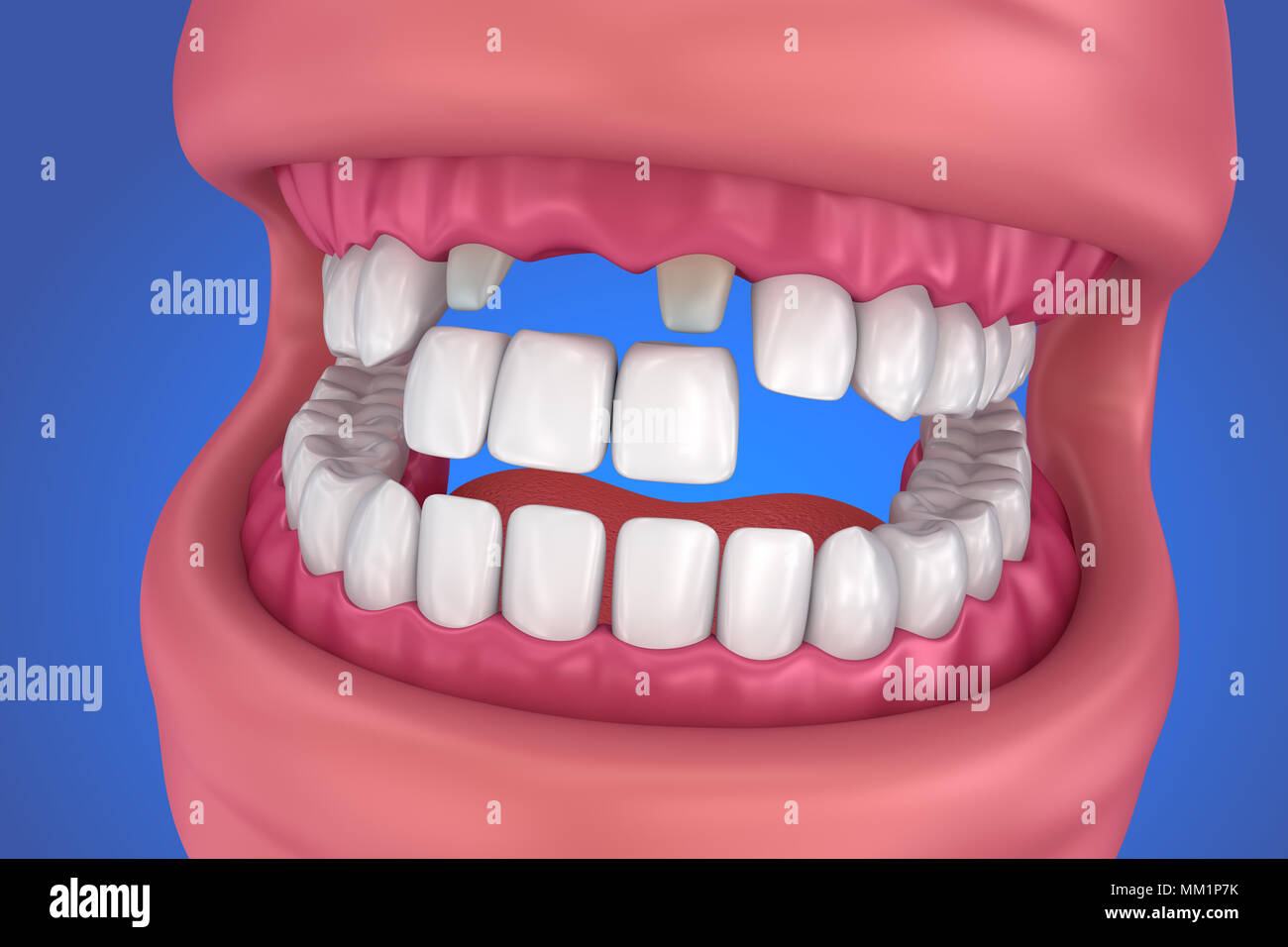 Tooth supported fixed bridge. Medically accurate 3D illustration Stock ...