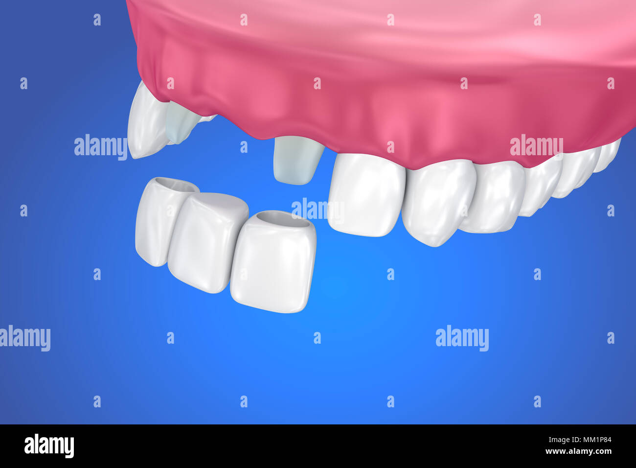 Tooth supported fixed bridge. Medically accurate 3D illustration Stock ...