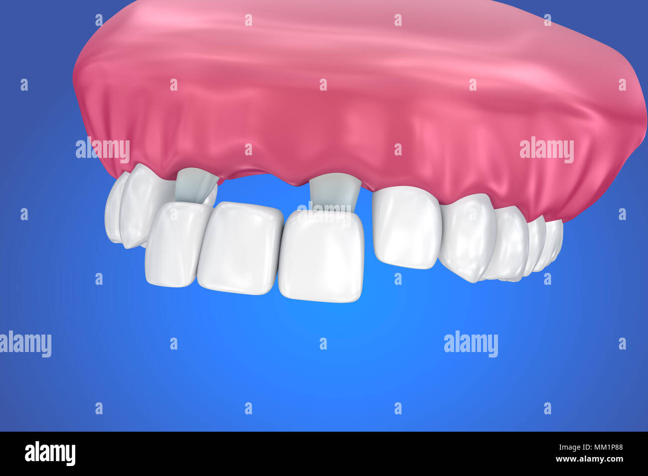 Tooth supported fixed bridge. Medically accurate 3D illustration Stock ...