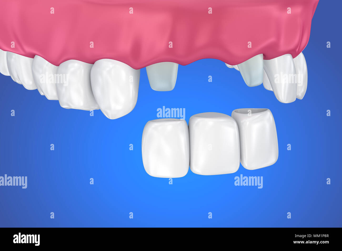 Tooth supported fixed bridge. Medically accurate 3D illustration Stock ...