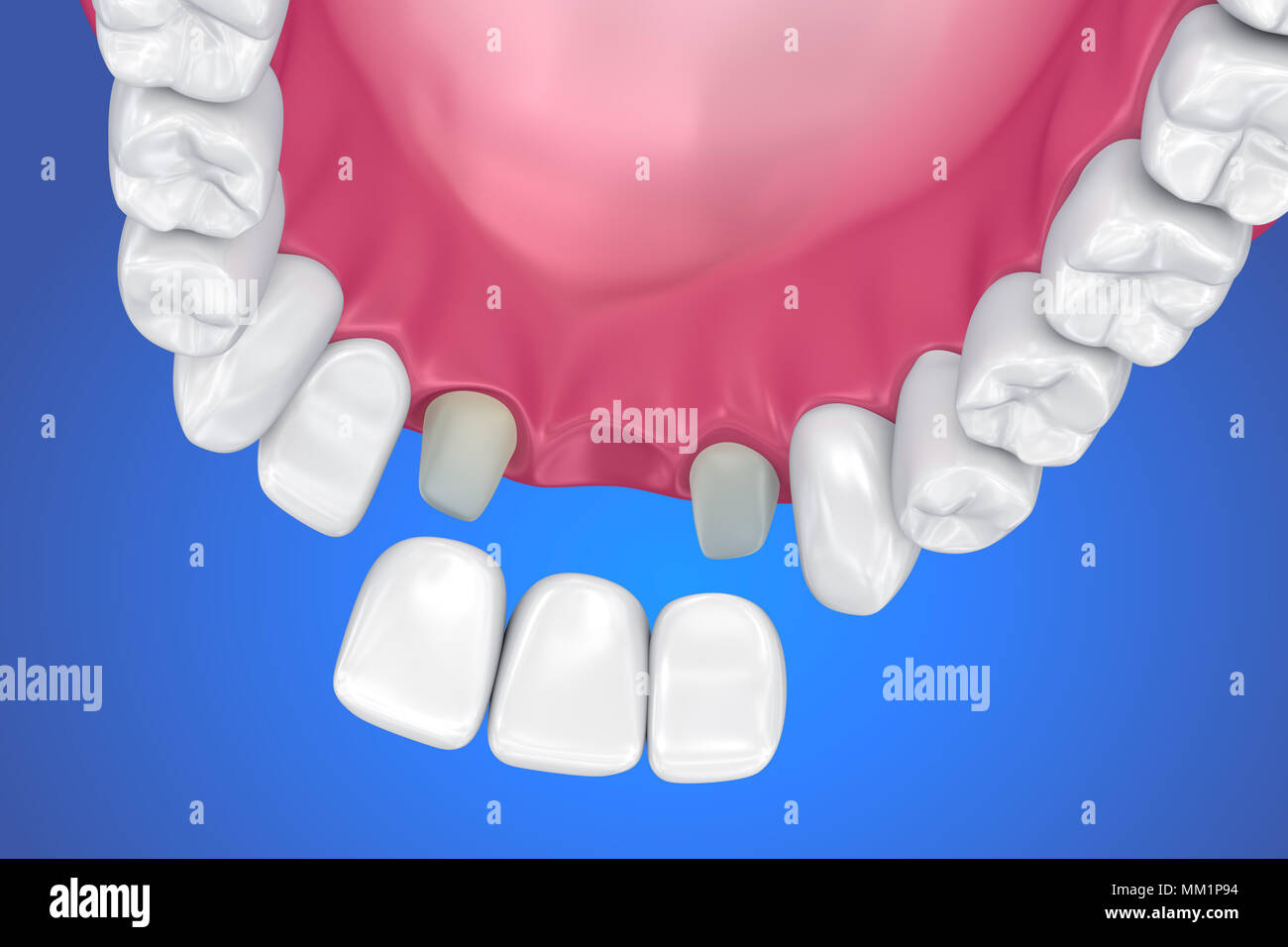 Tooth supported fixed bridge. Medically accurate 3D illustration Stock ...