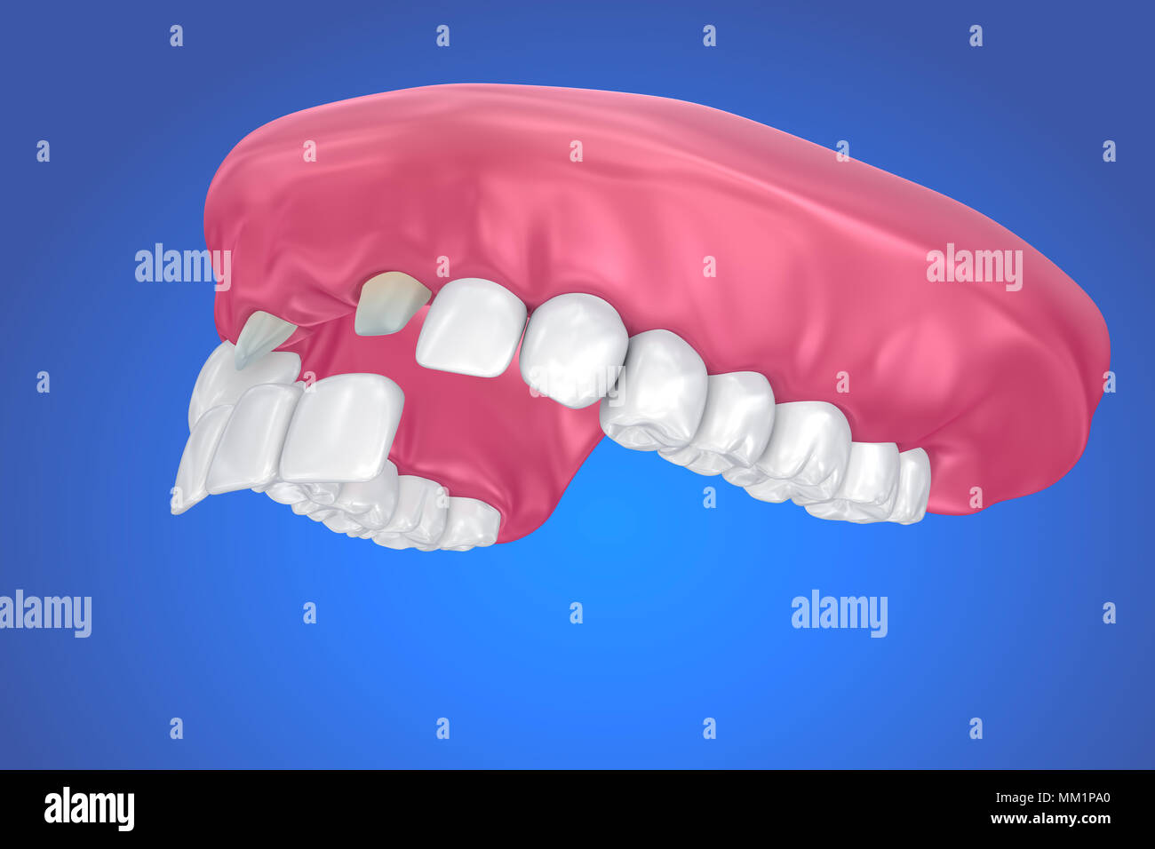 Tooth supported fixed bridge. Medically accurate 3D illustration Stock ...