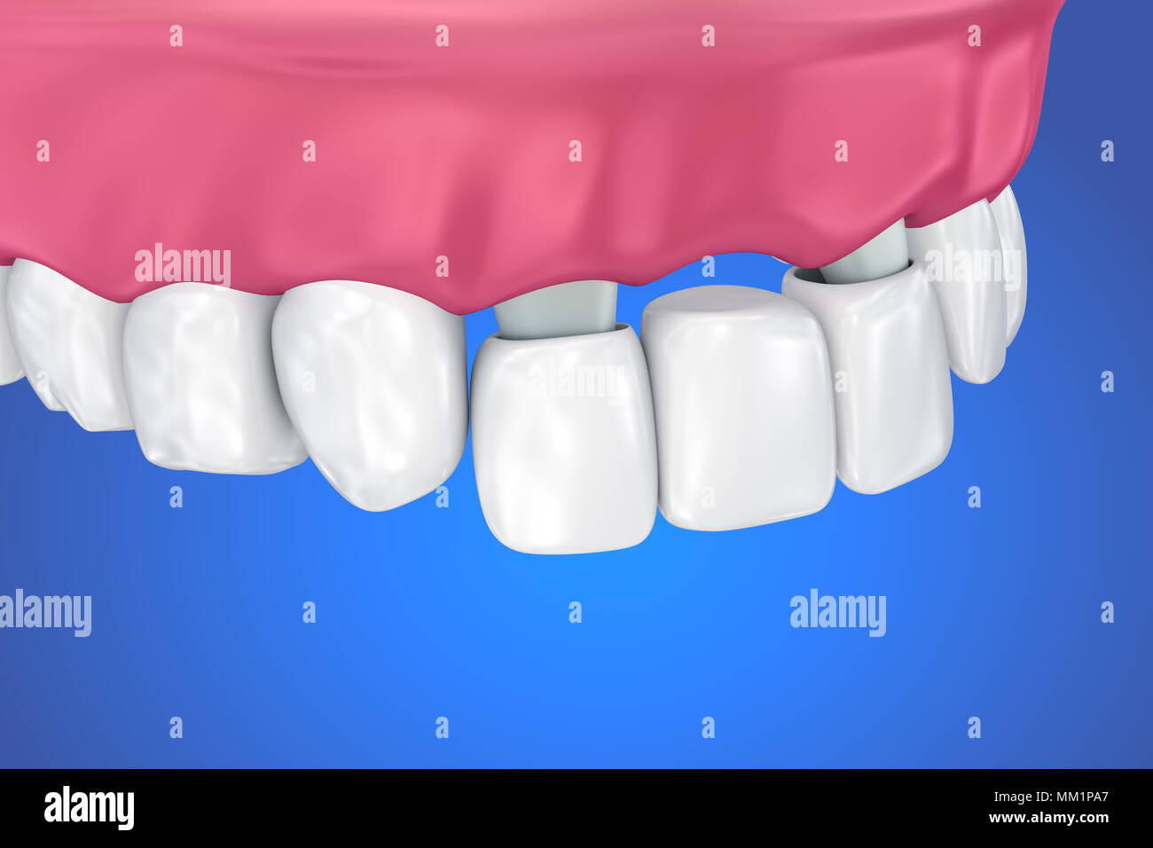 Tooth supported fixed bridge. Medically accurate 3D illustration Stock ...