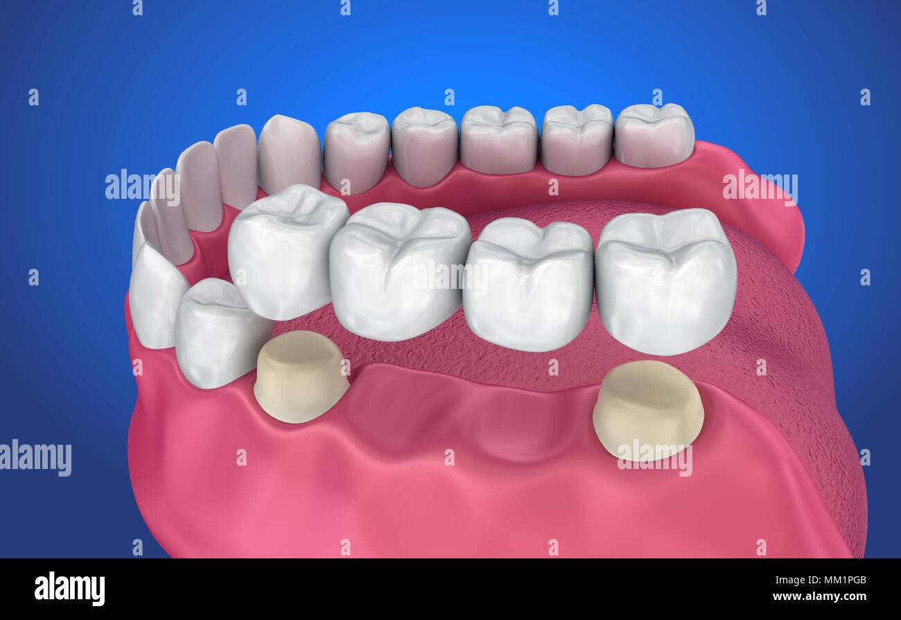 Tooth supported fixed bridge. Medically accurate 3D illustration Stock ...
