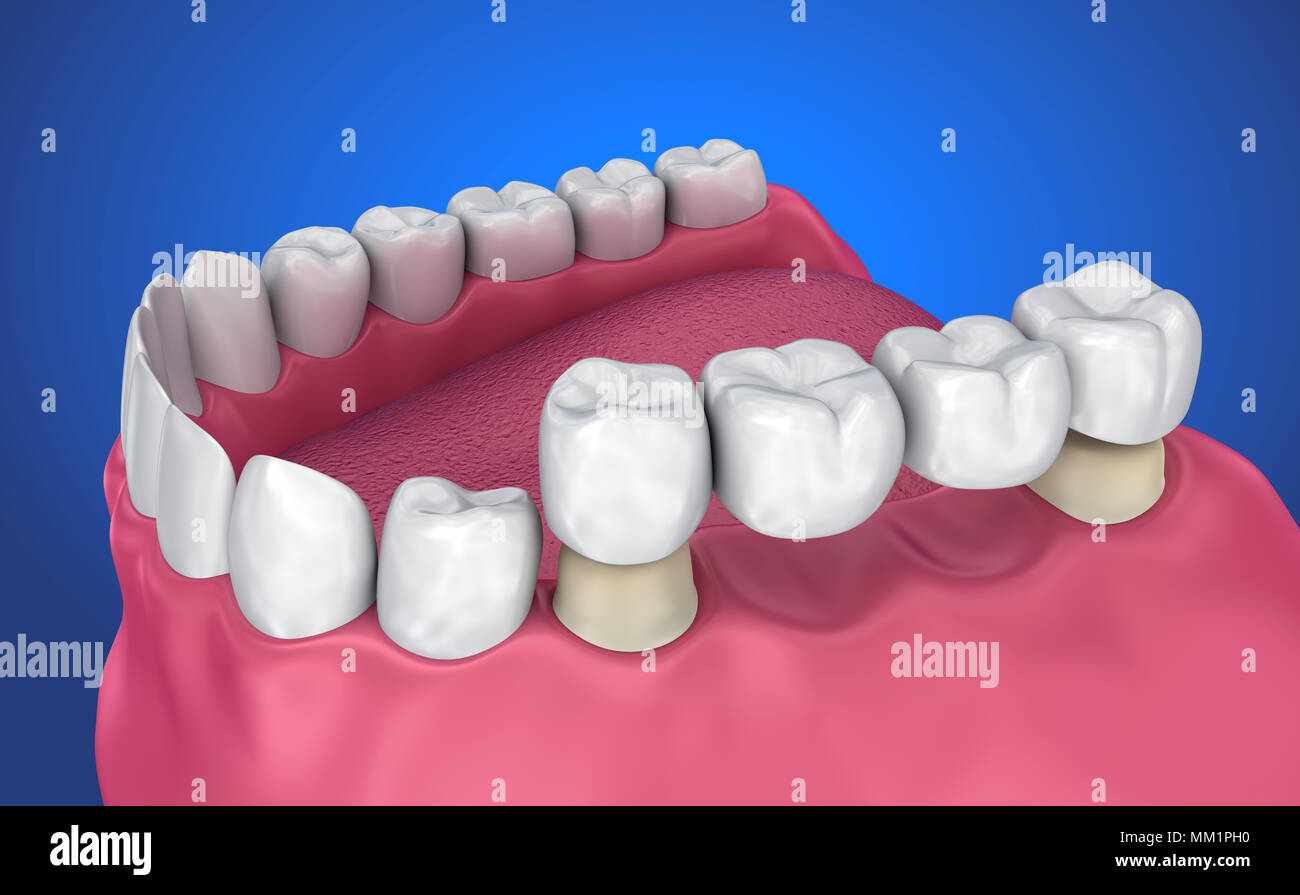 Tooth supported fixed bridge. Medically accurate 3D illustration Stock ...