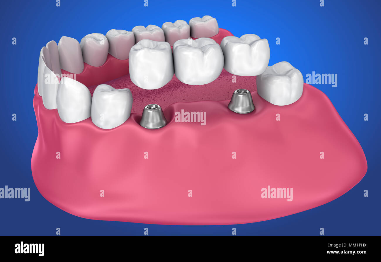 implant supported fixed bridge. Medically accurate 3D illustration ...