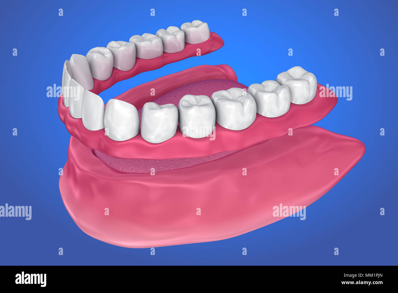 All missing teeth - removable full denture. 3D illustration Stock Photo ...