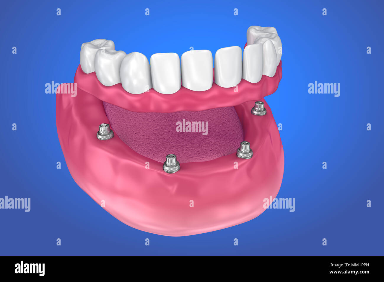 Fixed bridge on implants hi-res stock photography and images - Alamy