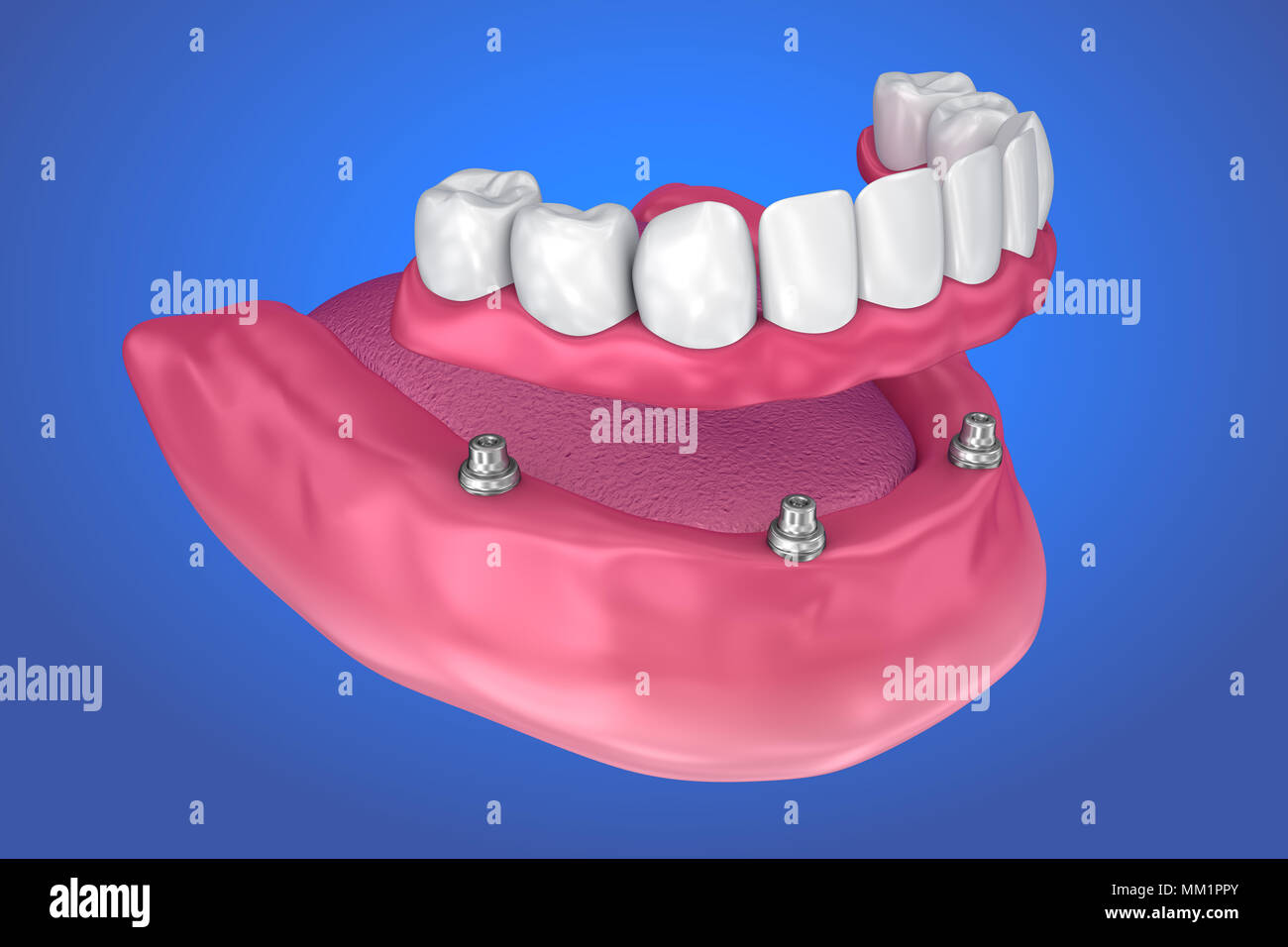 Fixed bridge on implants hi-res stock photography and images - Alamy