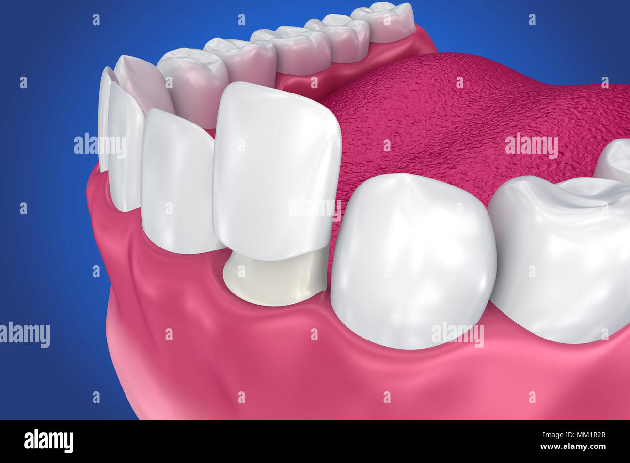 Dental Veneers: Porcelain Veneer installation Procedure. 3D ...
