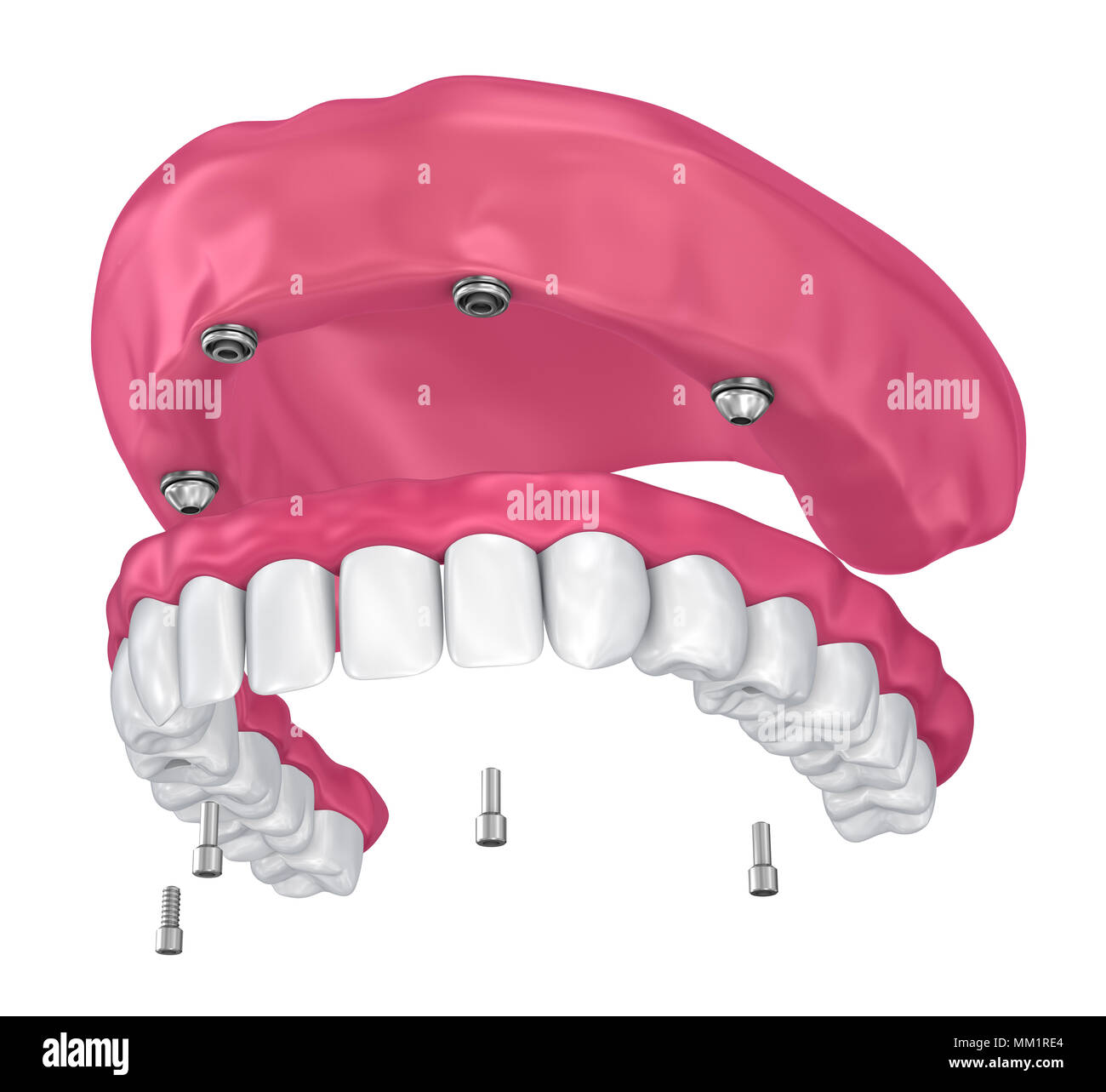 Overdenture to be seated on implants attachments. 3D illustration Stock ...