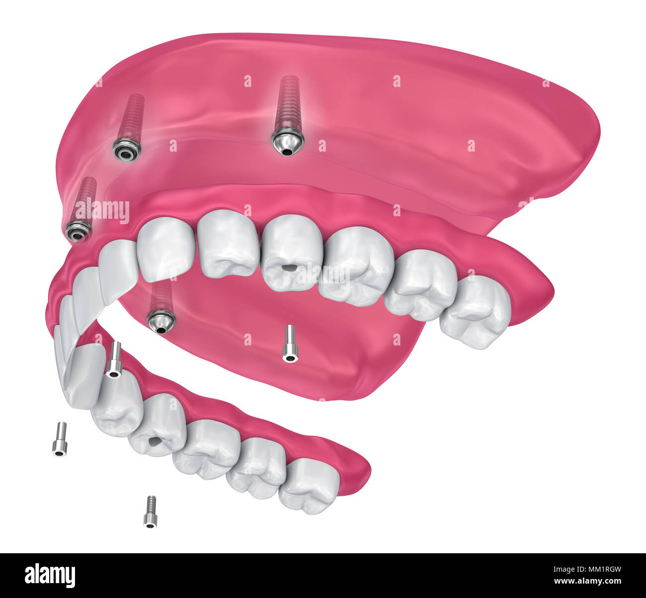 Overdenture to be seated on implants attachments. 3D illustration Stock ...