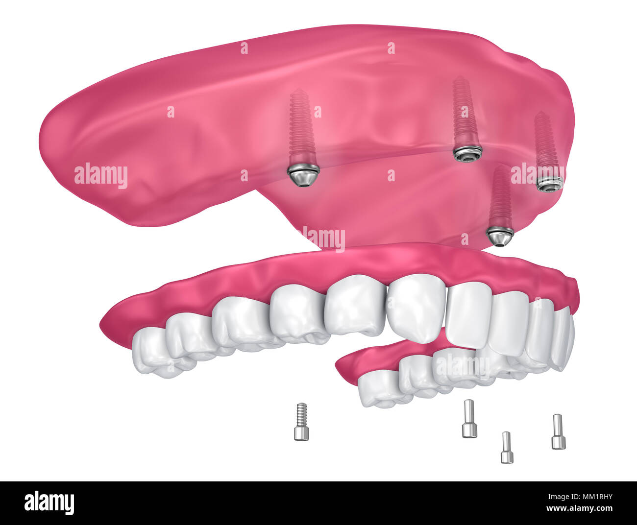 Overdenture to be seated on implants attachments. 3D illustration Stock ...