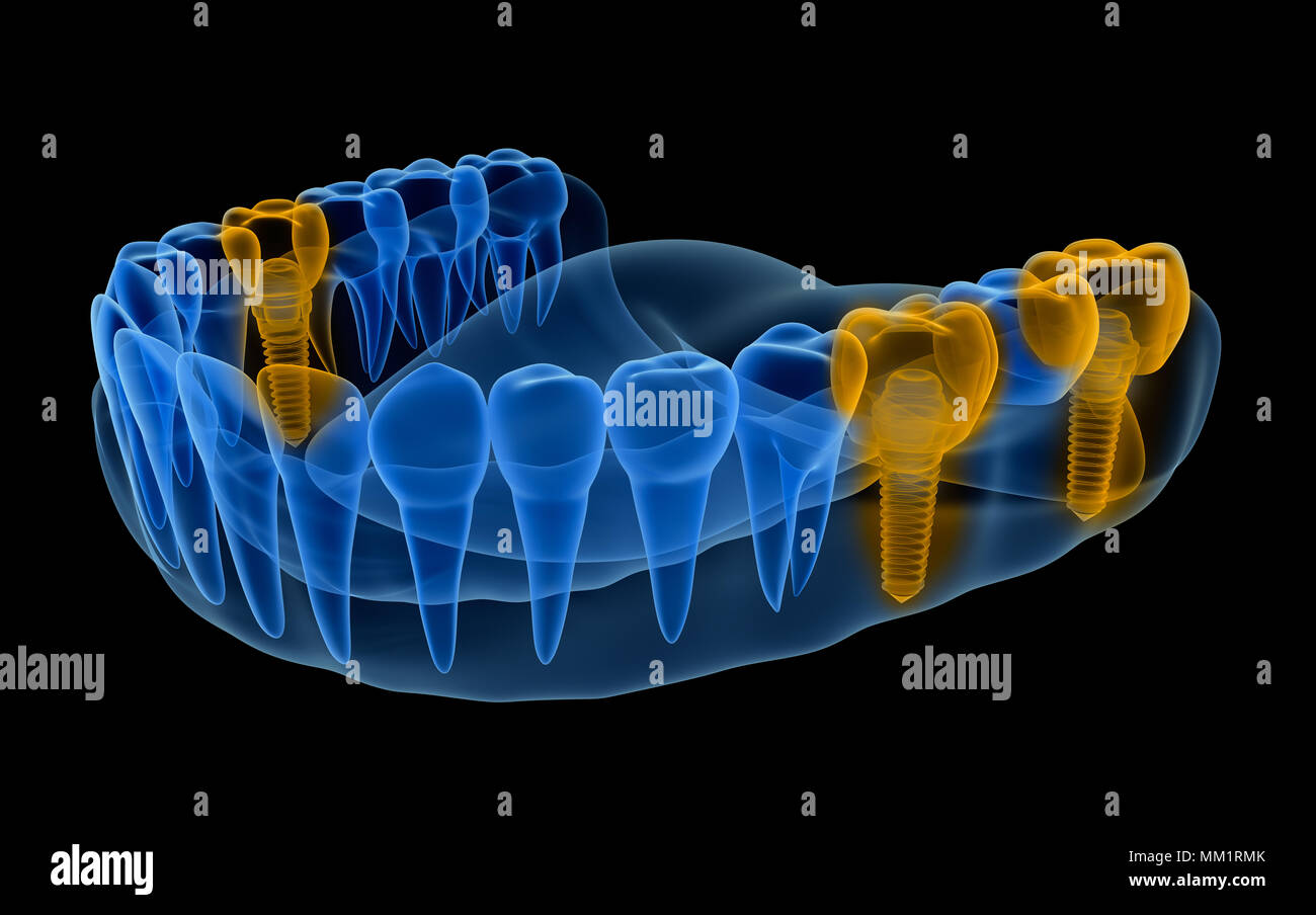 X-ray view of denture with implants . Xray view. Medically accurate 3D ...