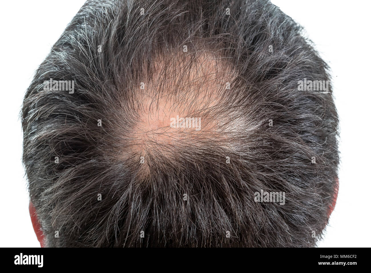 Alopecia male hi-res stock photography and images - Alamy