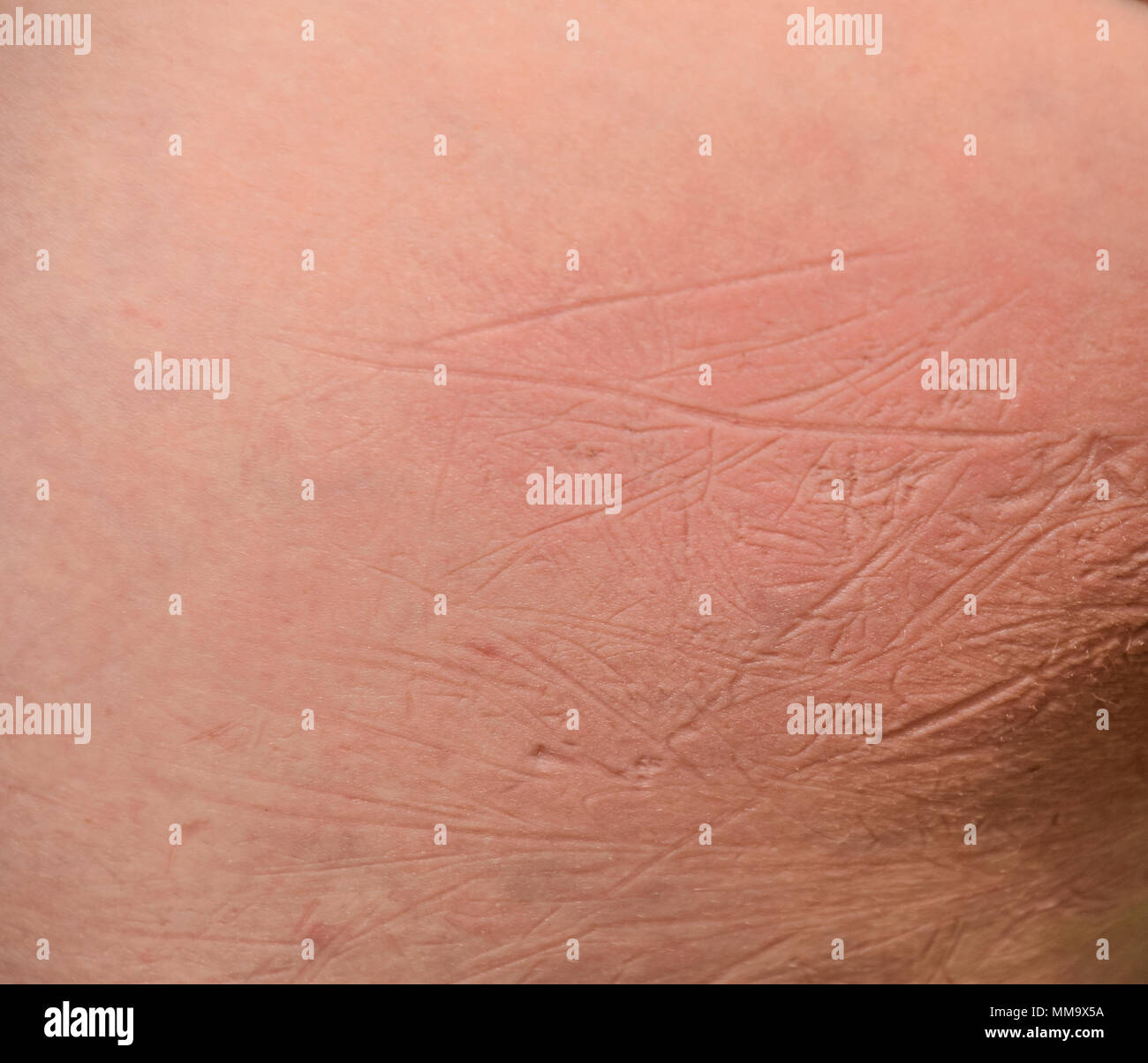 The texture of the skin on the buttock after a long sitting on the ...