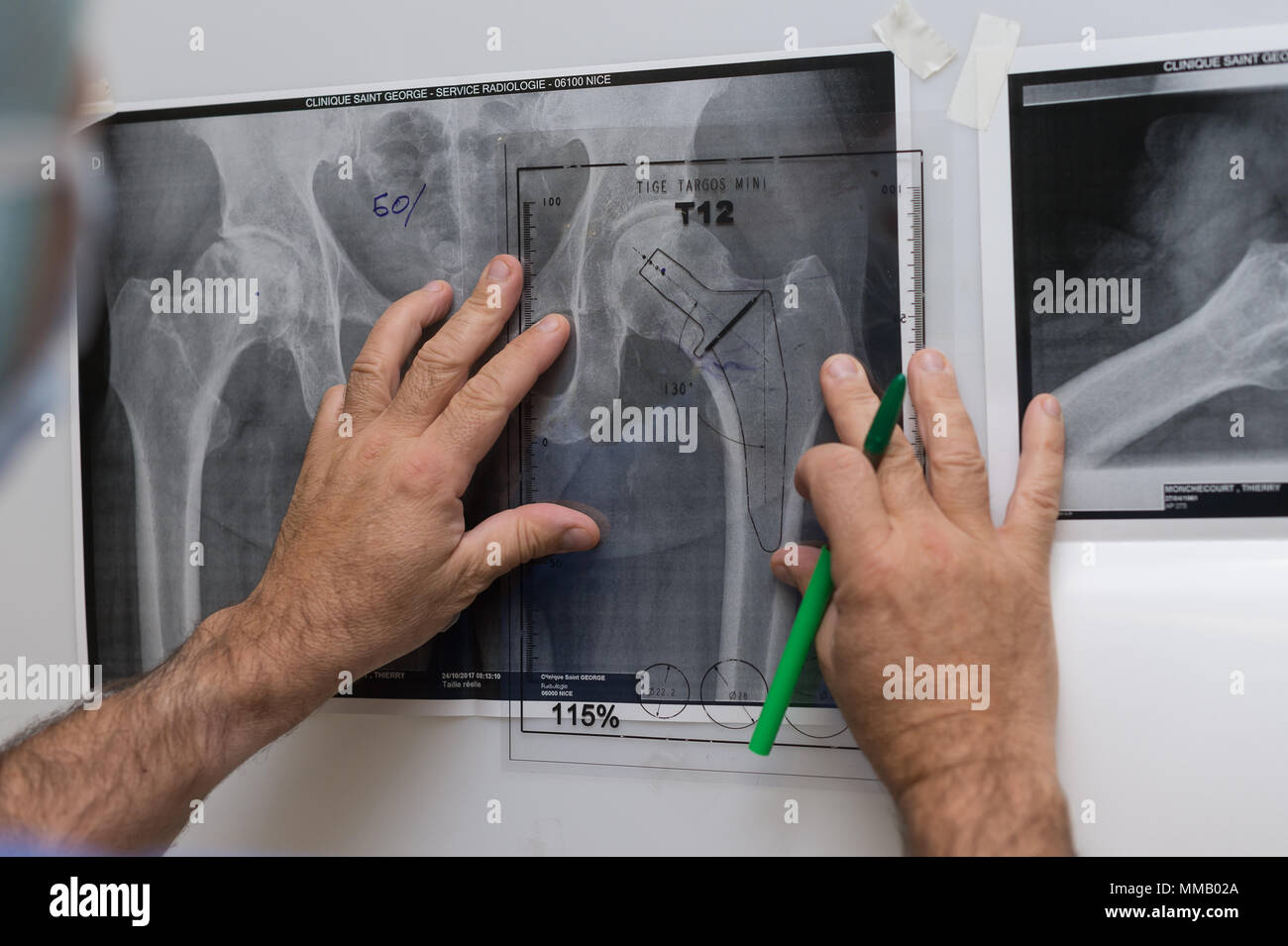 HIP PROSTHESIS, SURGERY Stock Photo - Alamy