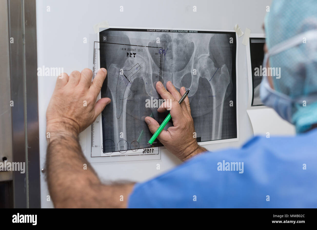 HIP PROSTHESIS, SURGERY Stock Photo - Alamy