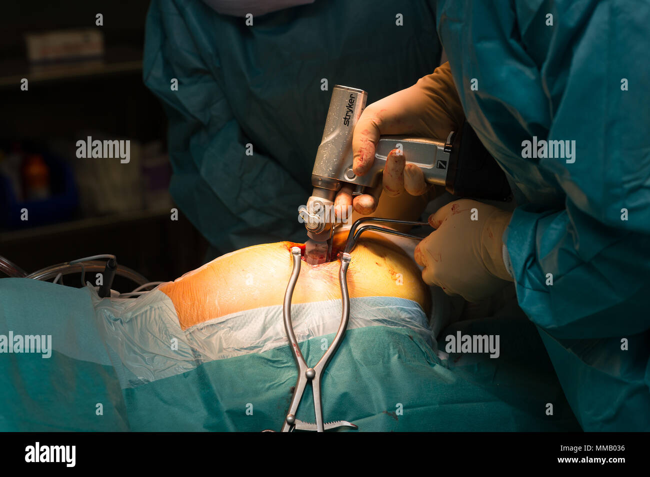 Detail of hip replacement operation prosthesis hi-res stock photography ...