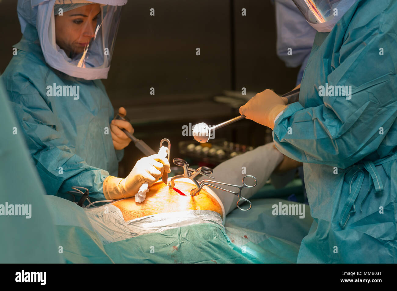 HIP PROSTHESIS, SURGERY Stock Photo - Alamy