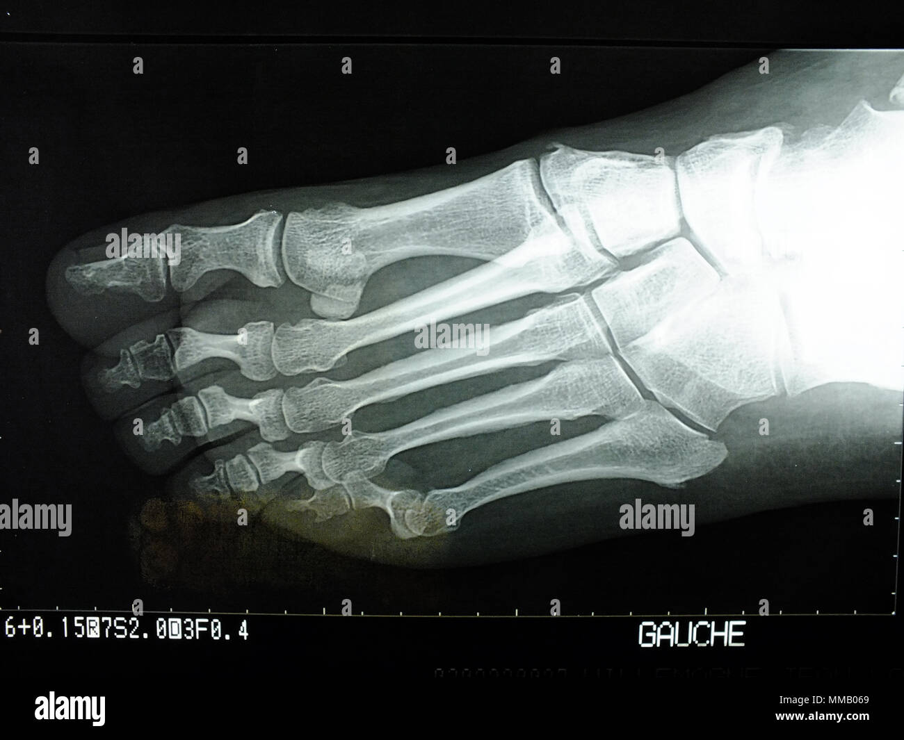 Radiograph foot hi-res stock photography and images - Alamy