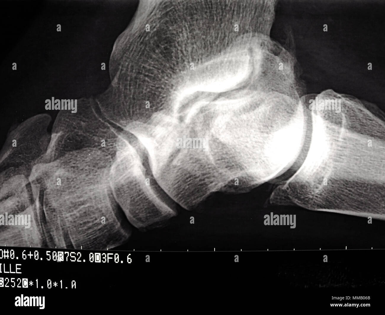 Normal ankle joint x ray hi-res stock photography and images - Alamy