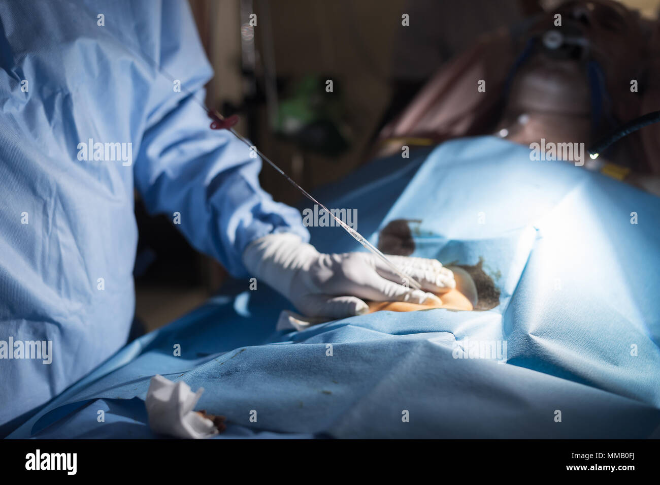 Gastrostomy hi-res stock photography and images - Alamy