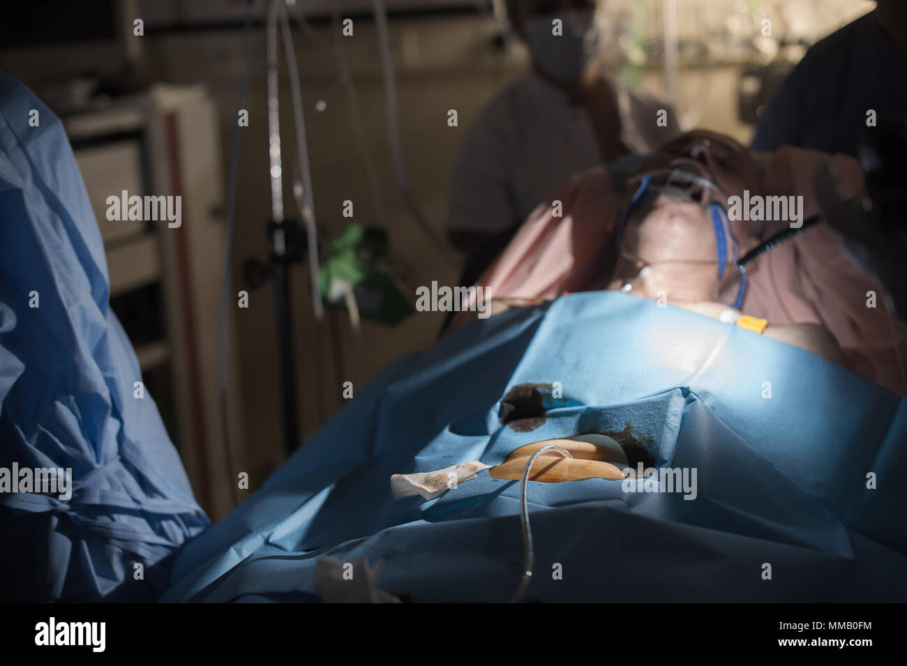 Gastrostomy hi-res stock photography and images - Alamy
