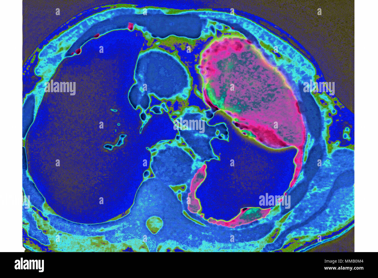 LUNG CANCER, CT SCAN Stock Photo - Alamy