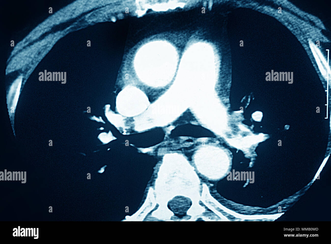 Pulmonary Trunk High Resolution Stock Photography and Images - Alamy