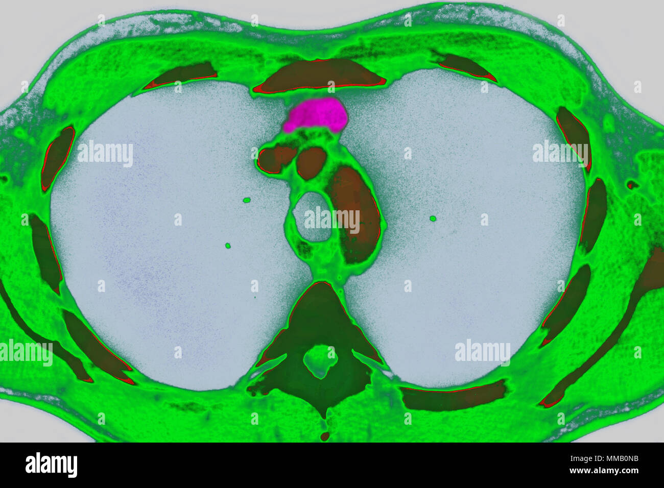 THYMUS CANCER, CT SCAN Stock Photo - Alamy