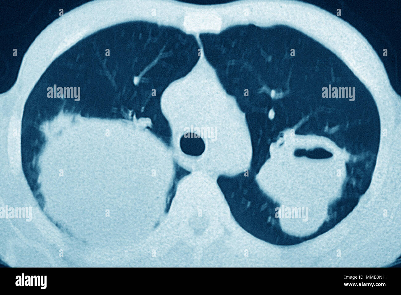 WEGENER'S DISEASE, CT SCAN Stock Photo - Alamy
