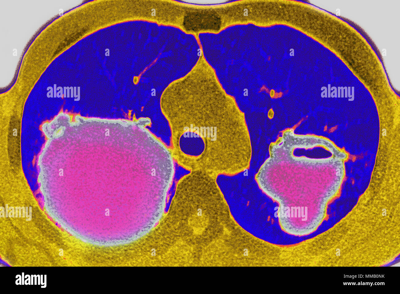 WEGENER'S DISEASE, CT SCAN Stock Photo - Alamy