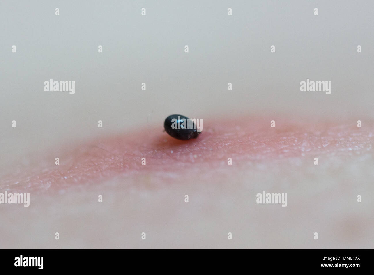 A parasitic tick on human skin with reddened inflamed area Stock Photo ...