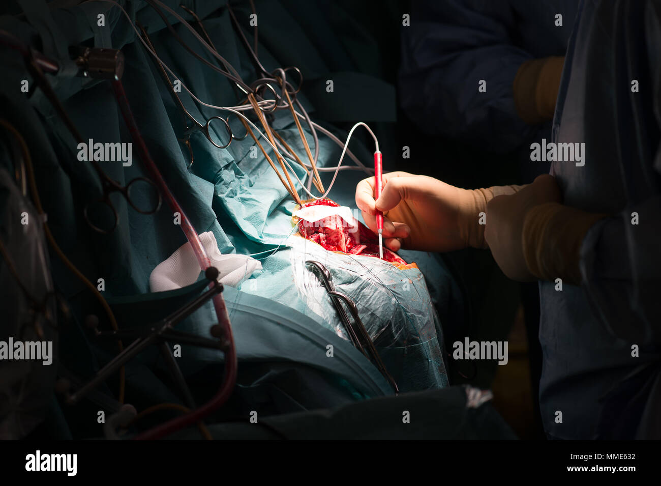 Brain surgery hi-res stock photography and images - Alamy