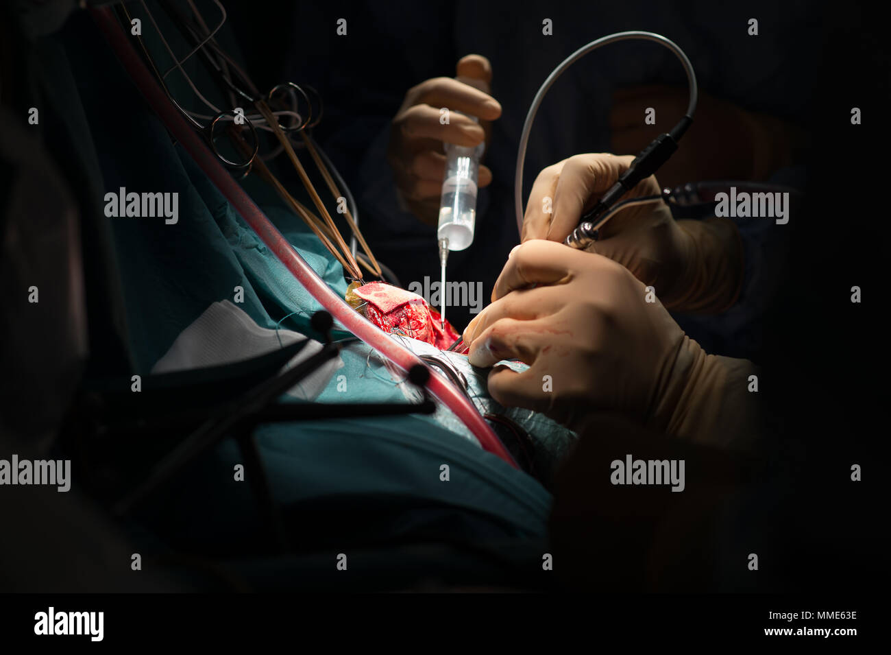 AWAKE BRAIN SURGERY Stock Photo - Alamy
